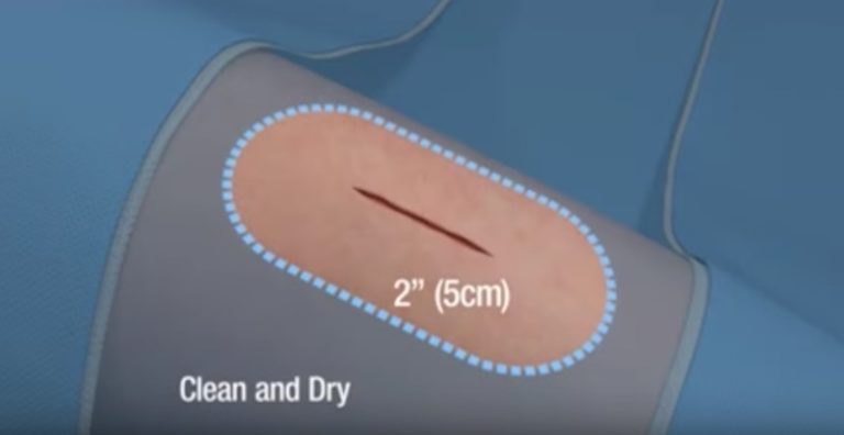 3M Steri Strips: Close Wounds Without Stitches